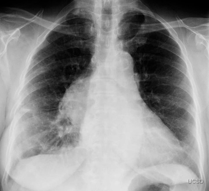 What Is A Foregut Duplication Cyst at Jack Black blog